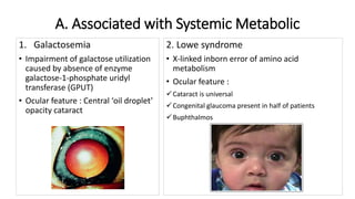 Congenital Catarct | PPTX