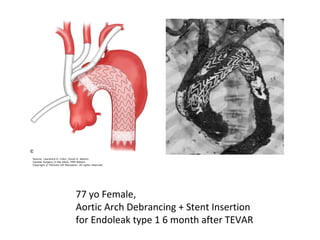 Surgery for Failed (T)EVAR | PPT