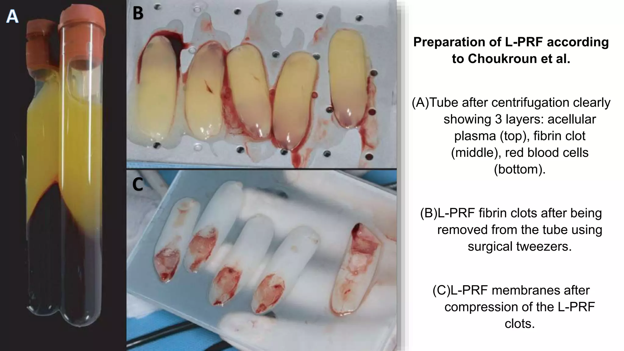 L-PRF for increasing the width of keratinized mucosa around implants: A ...