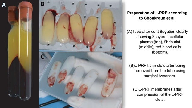 L-PRF for increasing the width of keratinized mucosa around implants: A ...