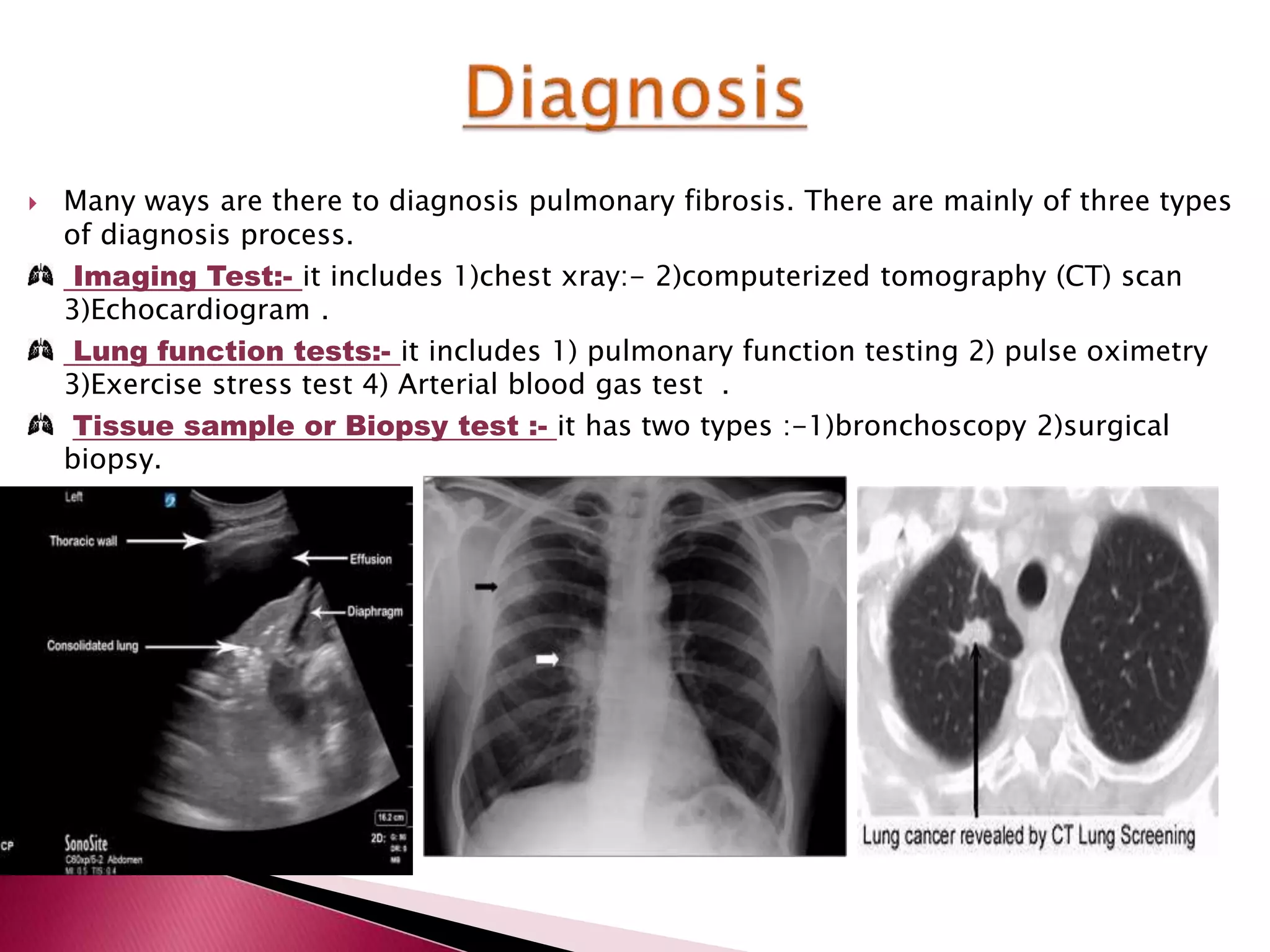 Pulmonary Fibrosis | PPTX