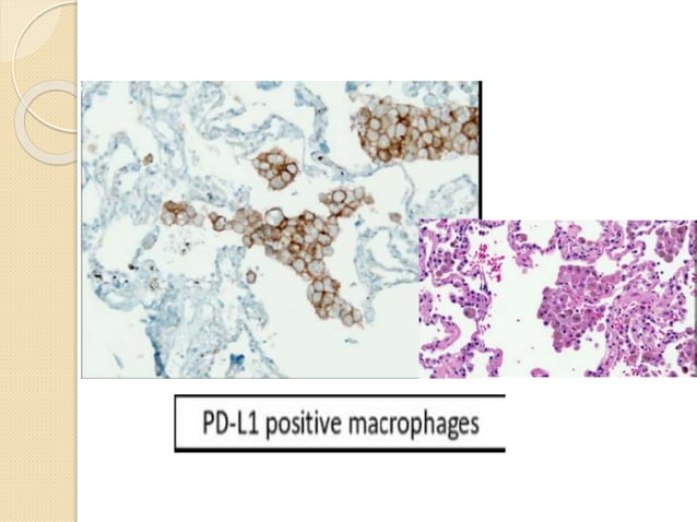 PD-L1 ROLE IN CANCER IMMUNOTHERAPY | PPTX | Cancer | Diseases and ...