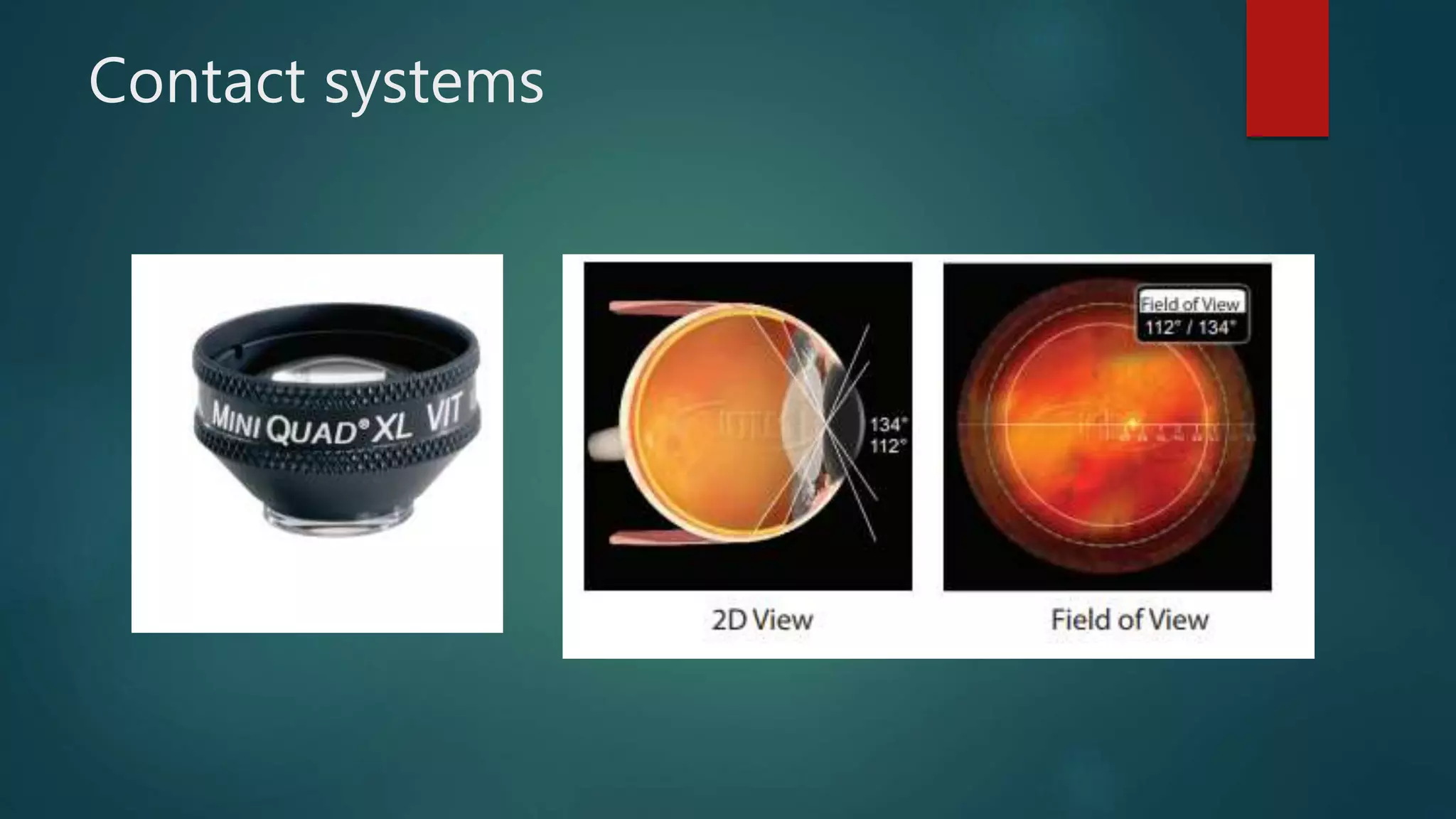 viewing systems in vitrectomy | PPTX