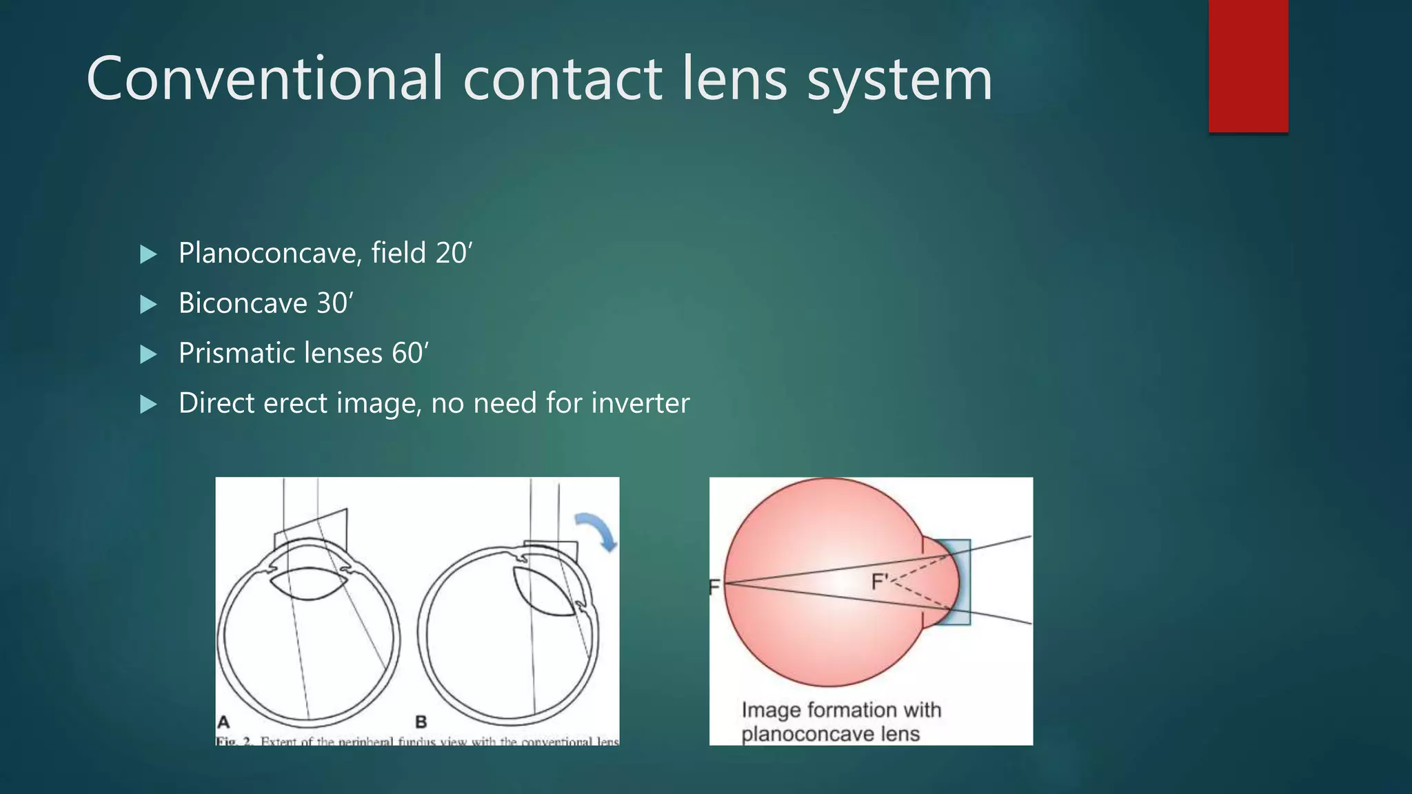 viewing systems in vitrectomy | PPTX