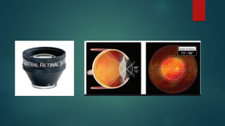 viewing systems in vitrectomy | PPTX