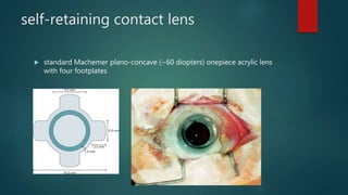 viewing systems in vitrectomy | PPTX