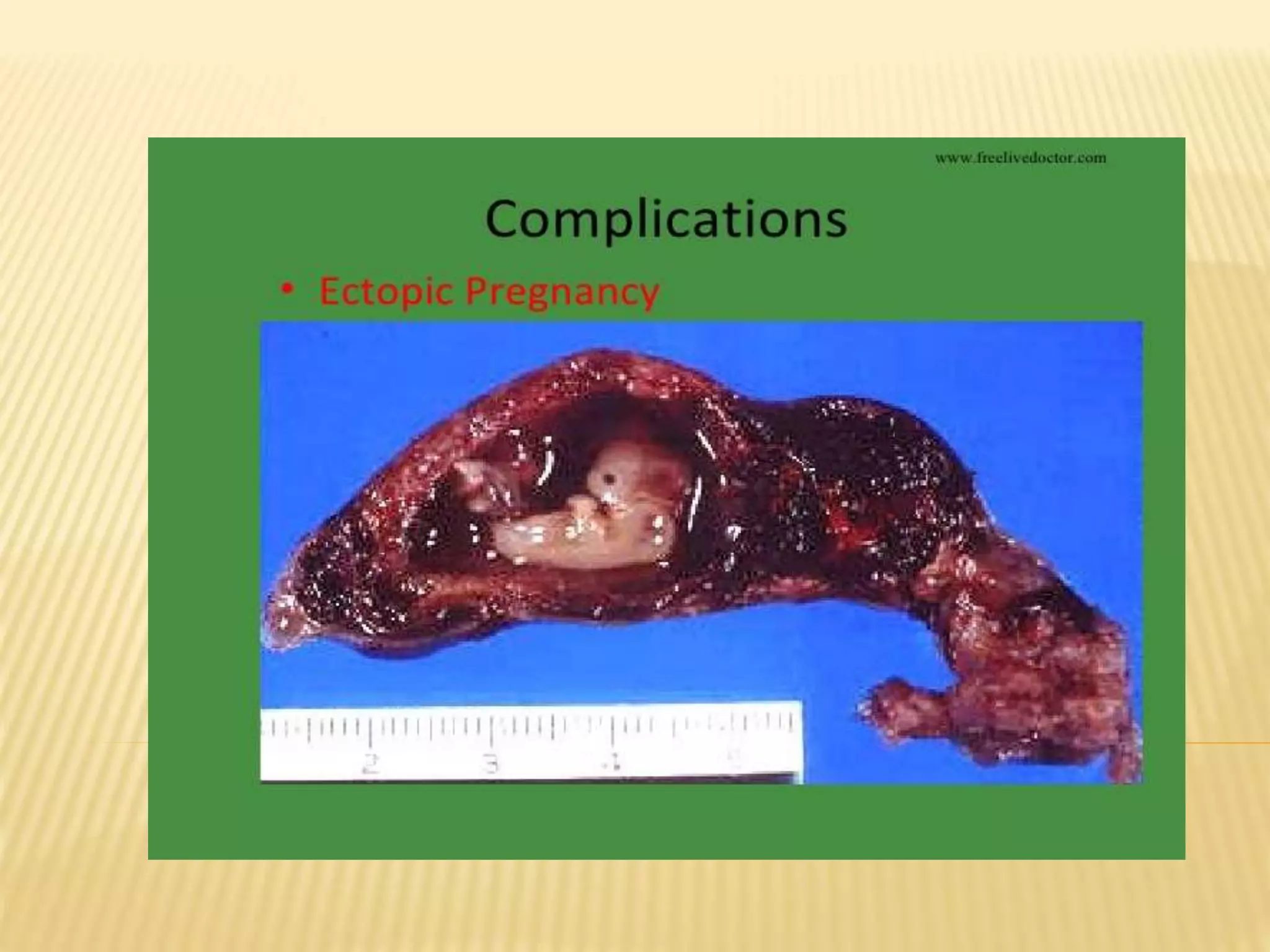 uterine adnexa diseases | PPT