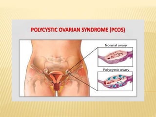 uterine adnexa diseases | PPT
