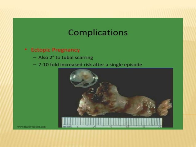 uterine adnexa diseases | PPT