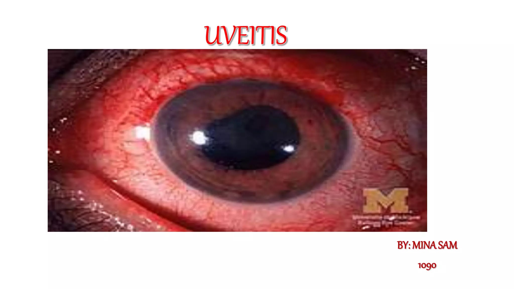 uveitis | PPT