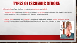 Ischemic Stroke | PPTX