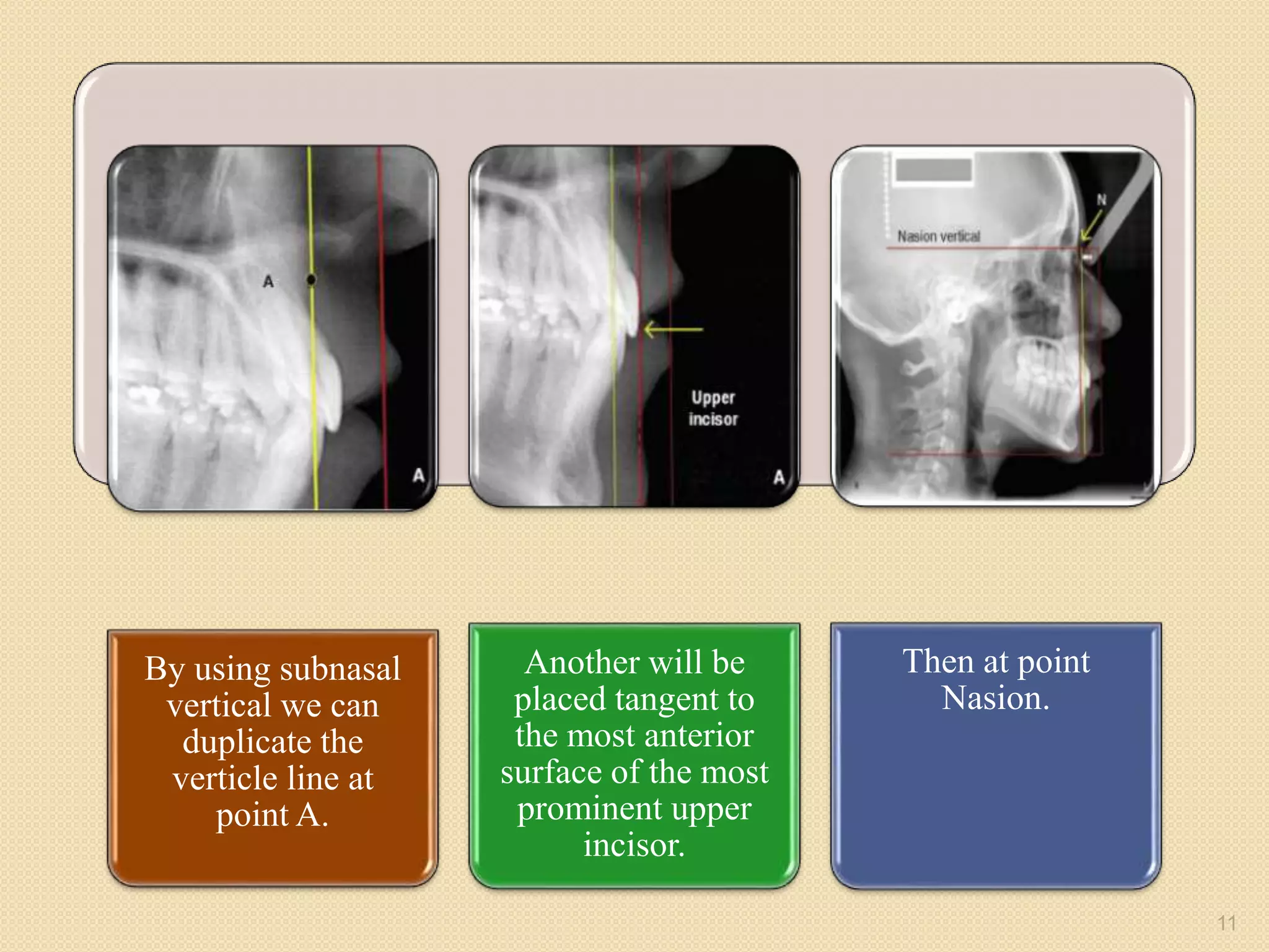 MICROSOFT CEPHALOMETRIC ANALYSIS | PPT