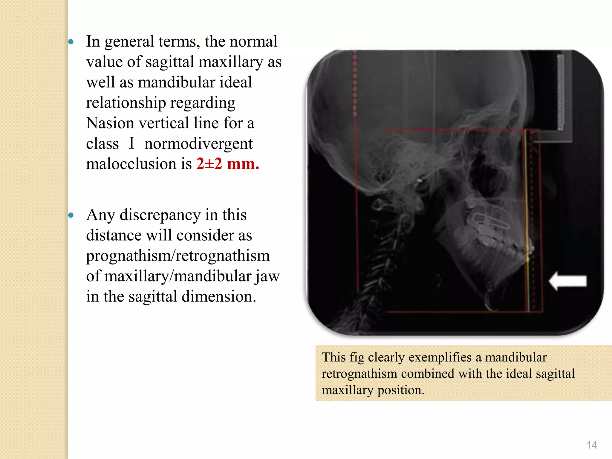 MICROSOFT CEPHALOMETRIC ANALYSIS | PPT