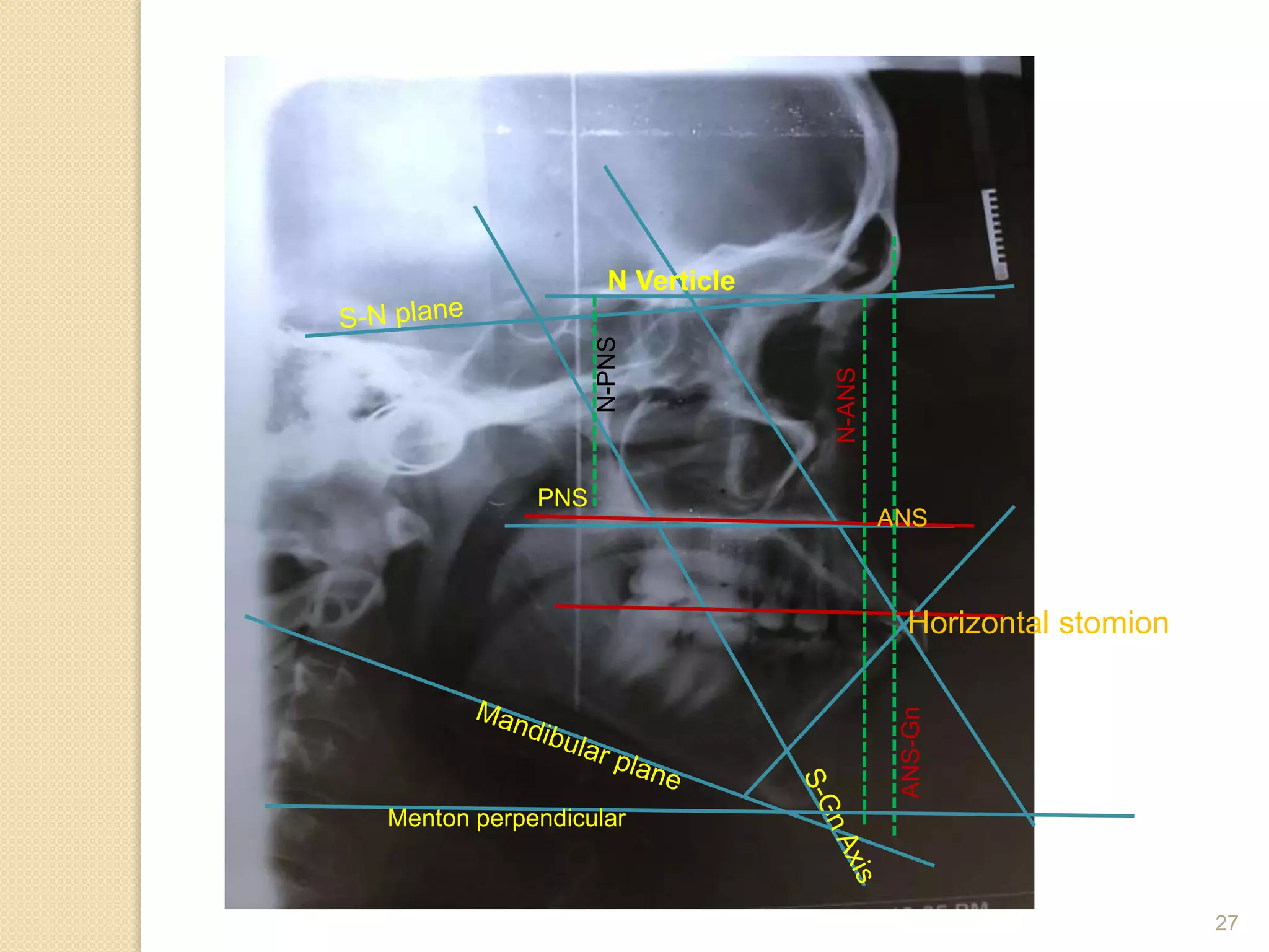 MICROSOFT CEPHALOMETRIC ANALYSIS | PPT
