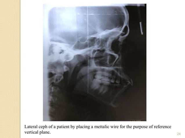 MICROSOFT CEPHALOMETRIC ANALYSIS | PPT