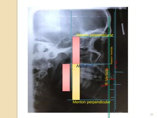 MICROSOFT CEPHALOMETRIC ANALYSIS | PPTX