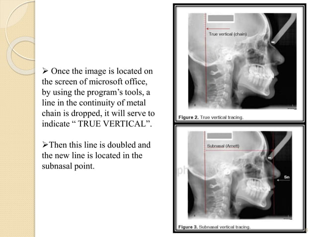 MICROSOFT CEPHALOMETRIC ANALYSIS | PPT