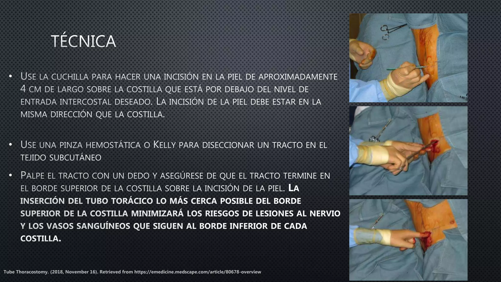 Toracotomía Cerrada | PPTX