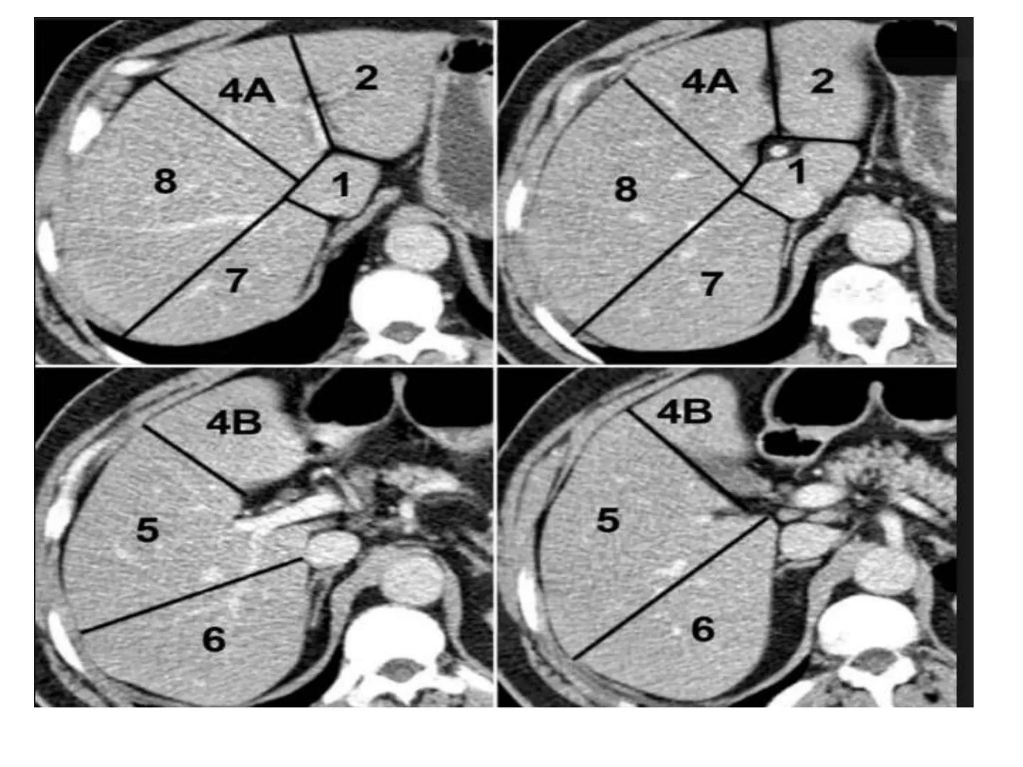 hepatobiliary imaging anatomy, Radiology | PPTX