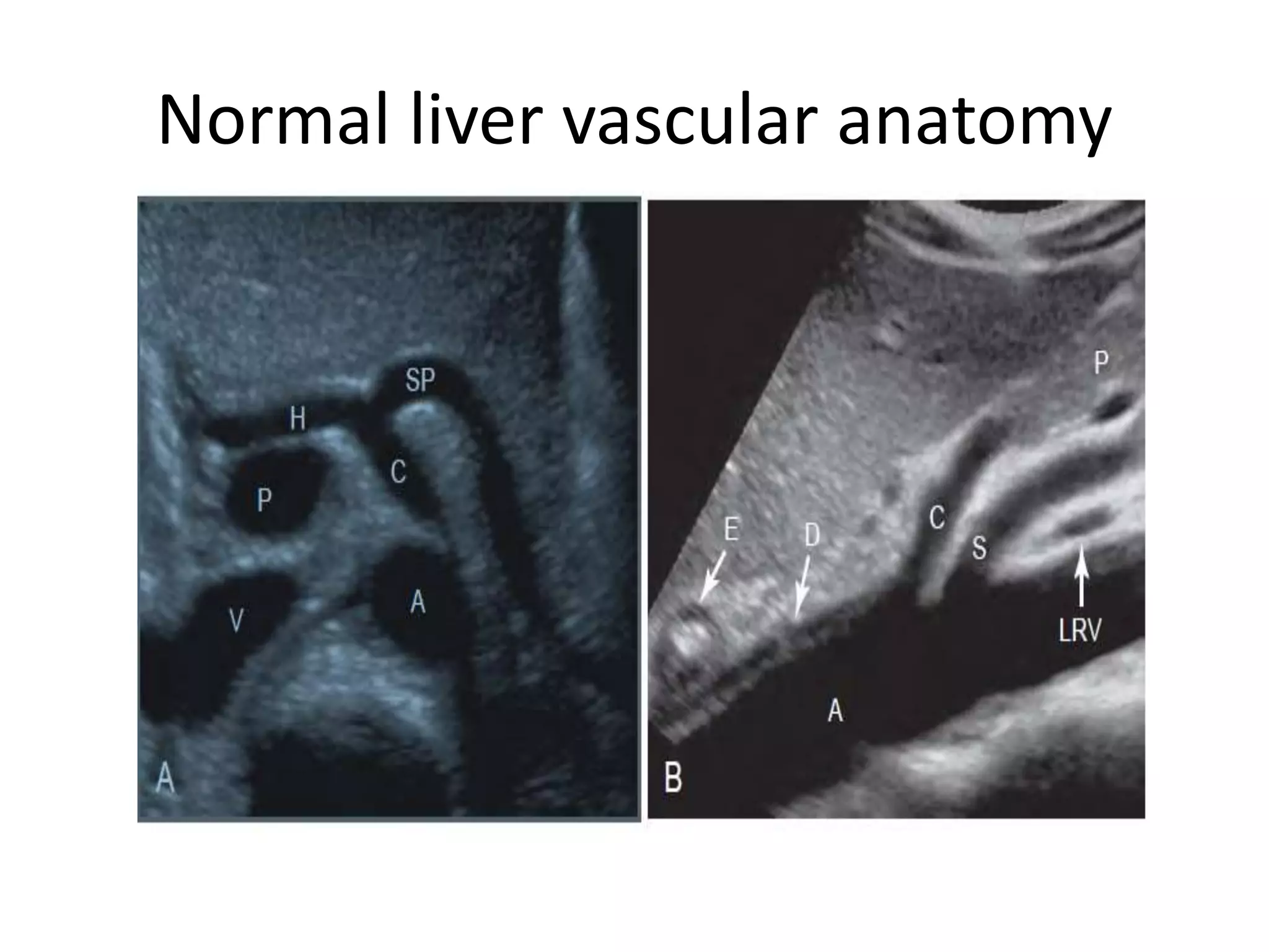 hepatobiliary imaging anatomy, Radiology | PPTX