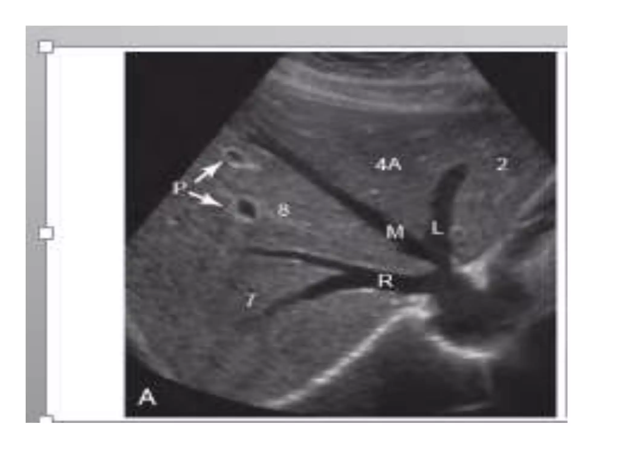 hepatobiliary imaging anatomy, Radiology | PPTX