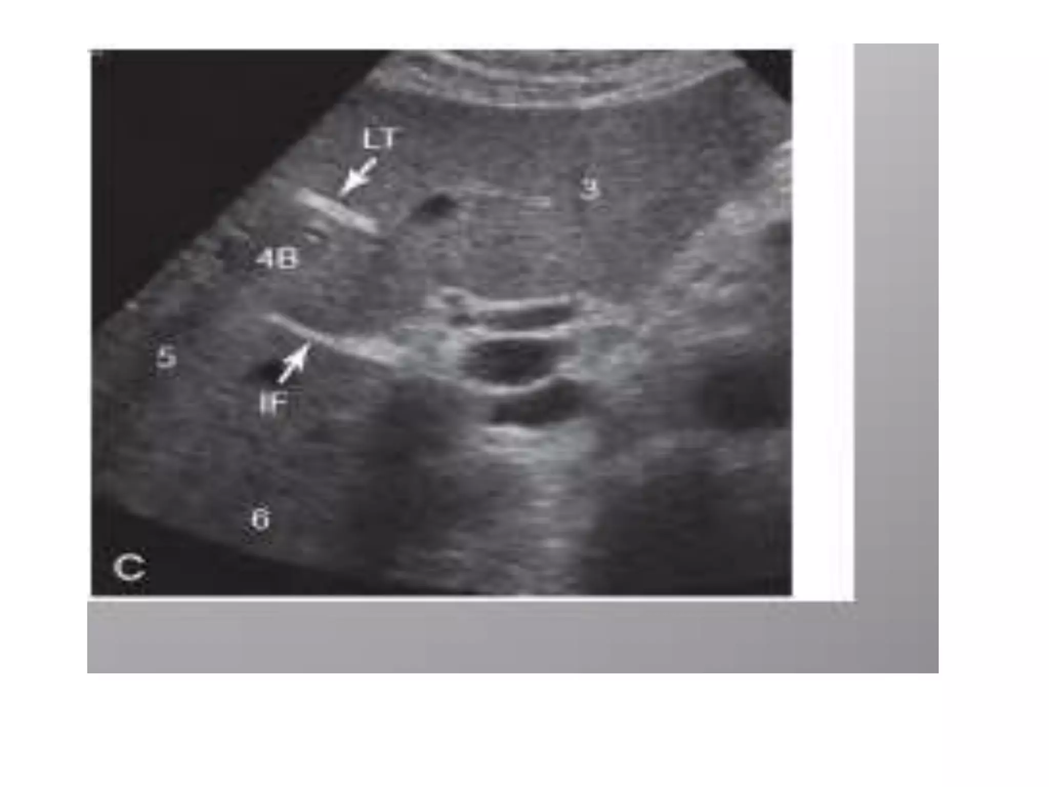 hepatobiliary imaging anatomy, Radiology | PPTX