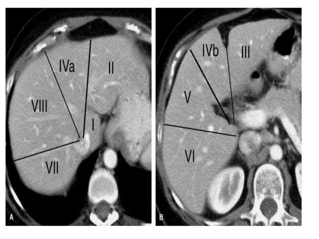 hepatobiliary imaging anatomy, Radiology | PPTX