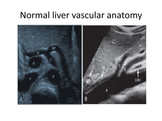 hepatobiliary imaging anatomy, Radiology | PPT
