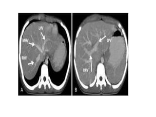 hepatobiliary imaging anatomy, Radiology | PPTX