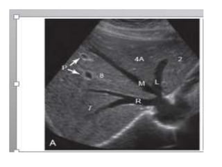hepatobiliary imaging anatomy, Radiology | PPTX