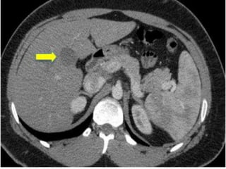 hepatobiliary imaging anatomy, Radiology | PPTX