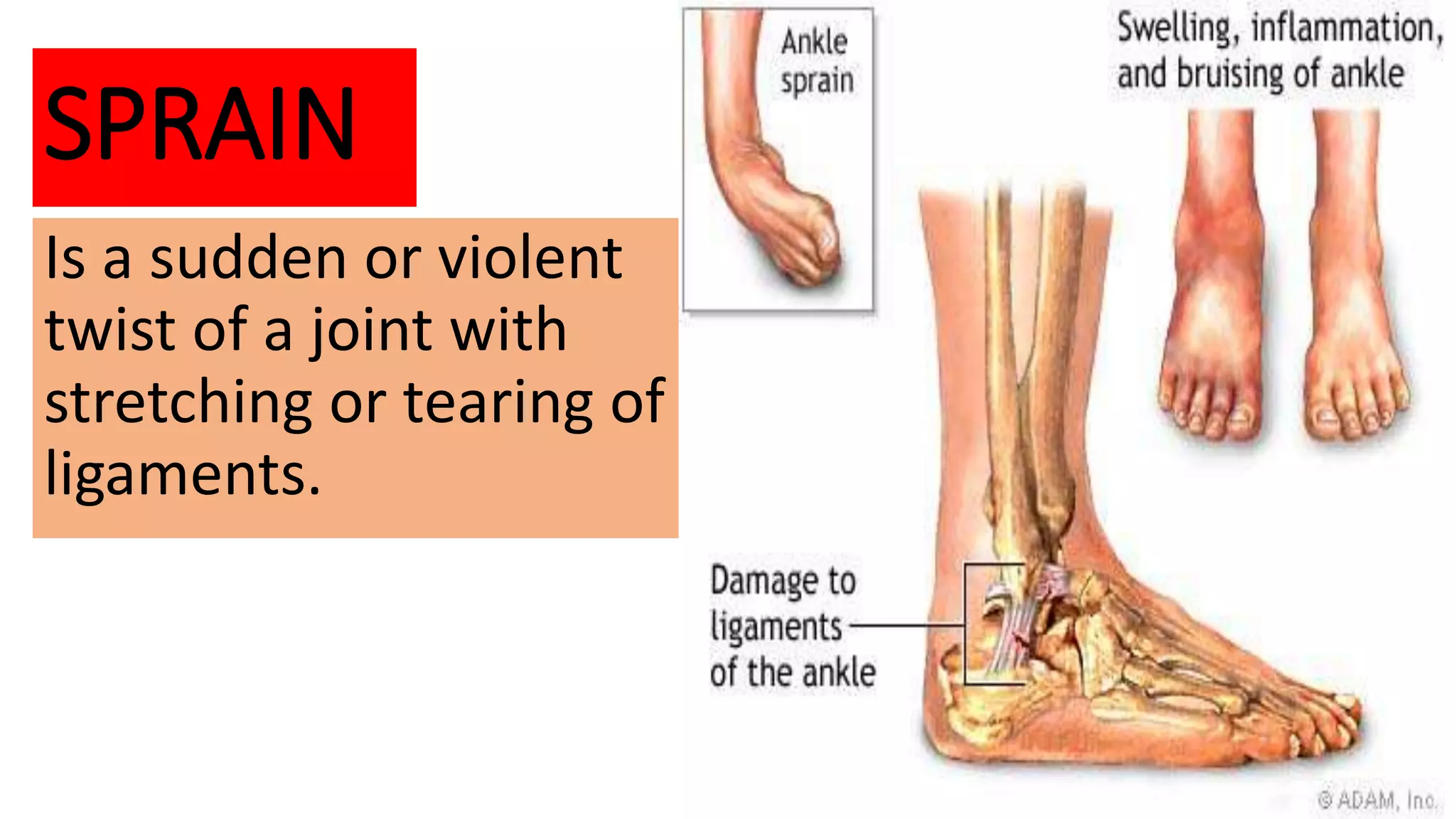 Common Sports Injuries | PPT