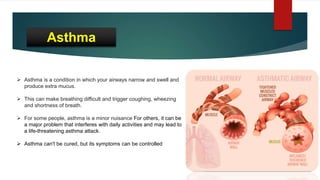 Management of asthma | PPTX