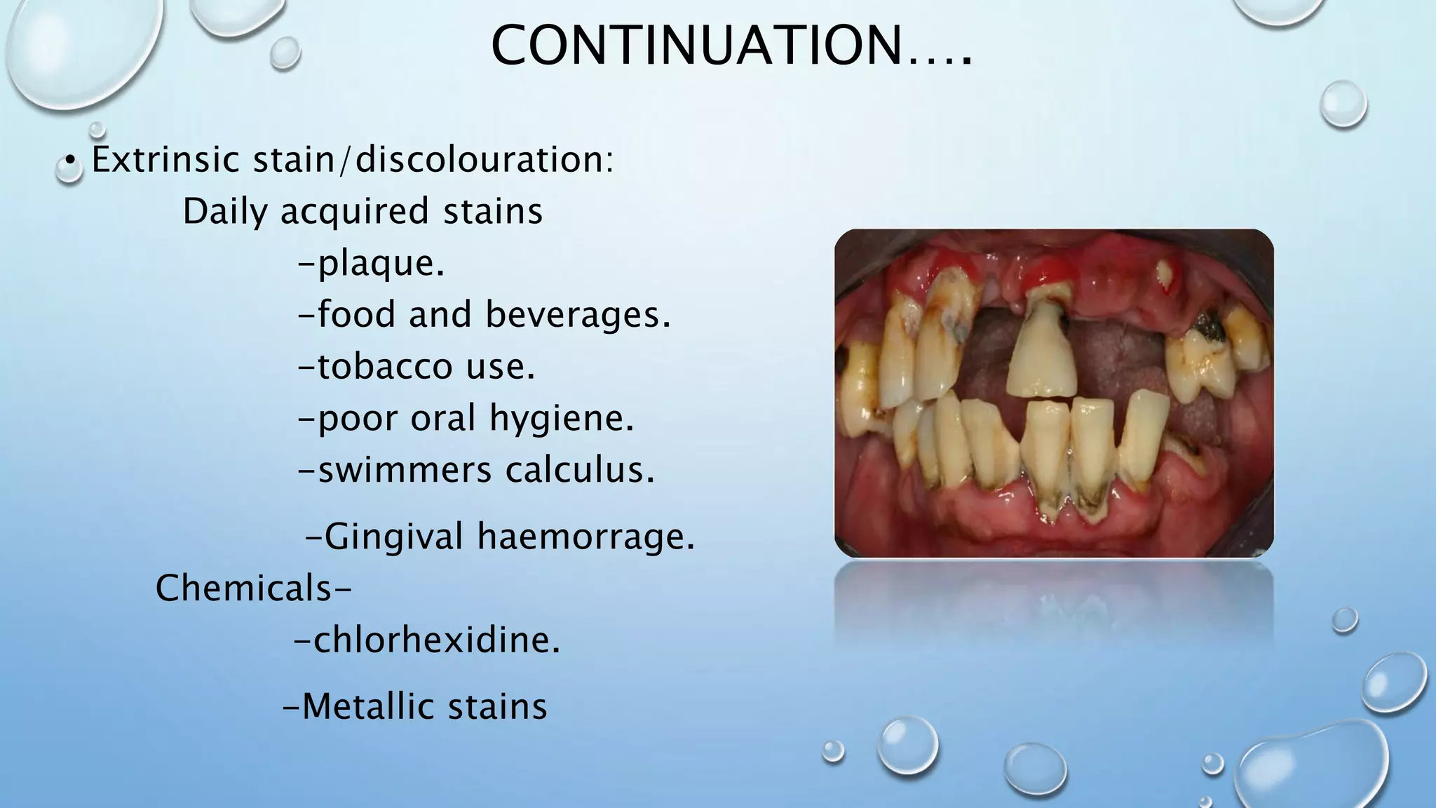 Management of discolored tooth | PPTX