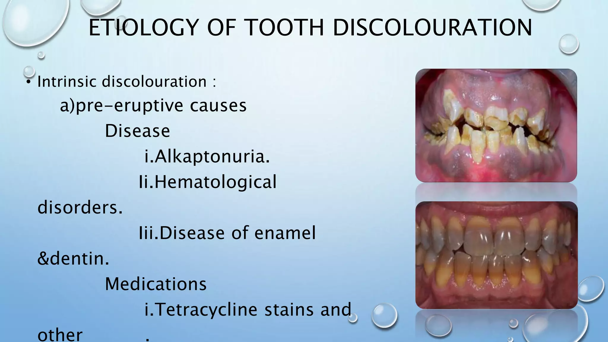 Management of discolored tooth | PPTX