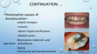 Management of discolored tooth | PPTX