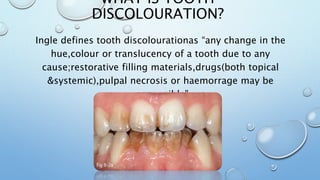 Management of discolored tooth | PPTX
