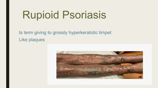 Pityriasis and psoriasis | PPTX