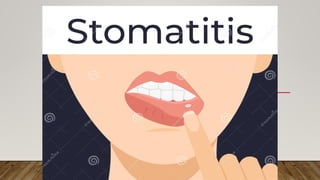 Stomatitis presentation Adult health Nursing | PDF