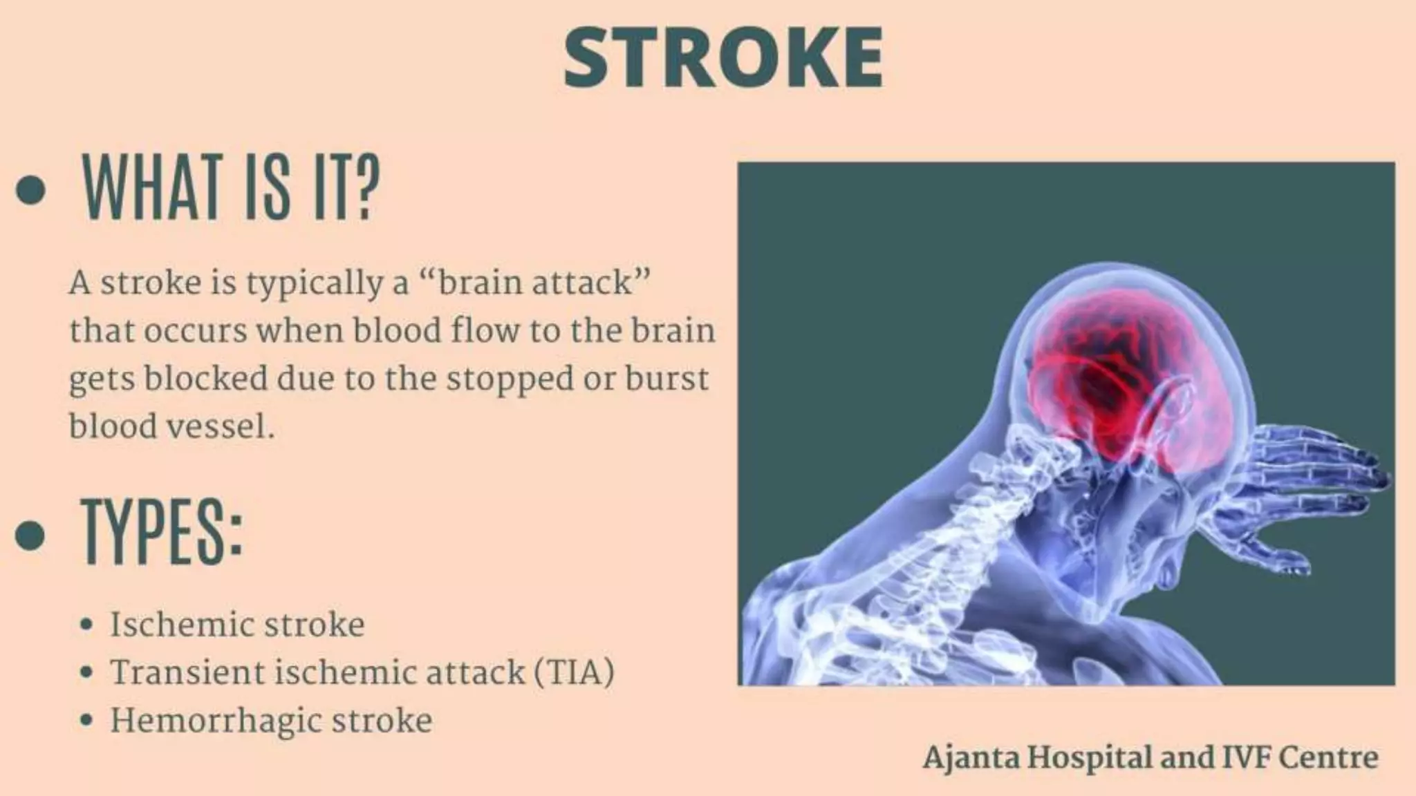 Understanding Heart Attack, Cardiac Arrest and Stroke | PPTX