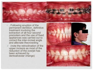 classII division 1 malocclusion | PPTX