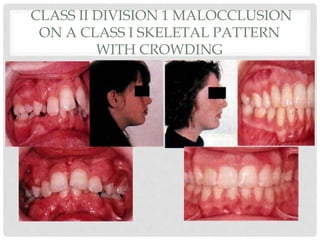 classII division 1 malocclusion | PPTX