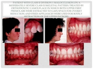 classII division 1 malocclusion | PPTX