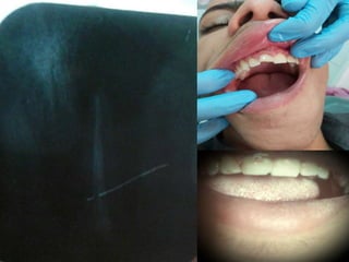 pup and periapical diagnoses | PPTX