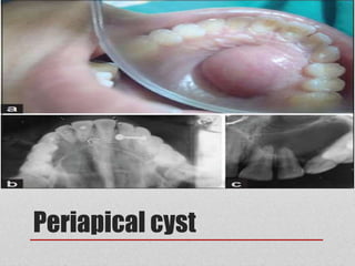 pup and periapical diagnoses | PPTX