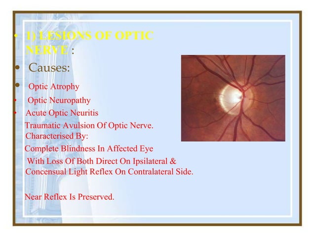 OPTIC NERVE & VISUAL PATHWAY | PPTX | Eye and Vision Conditions ...