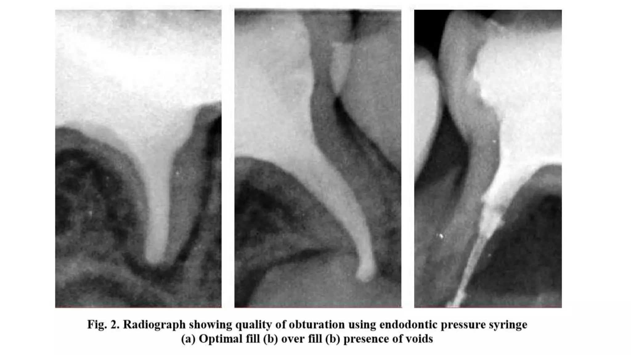 Obturation Techniques in Primary Teeth | PPTX