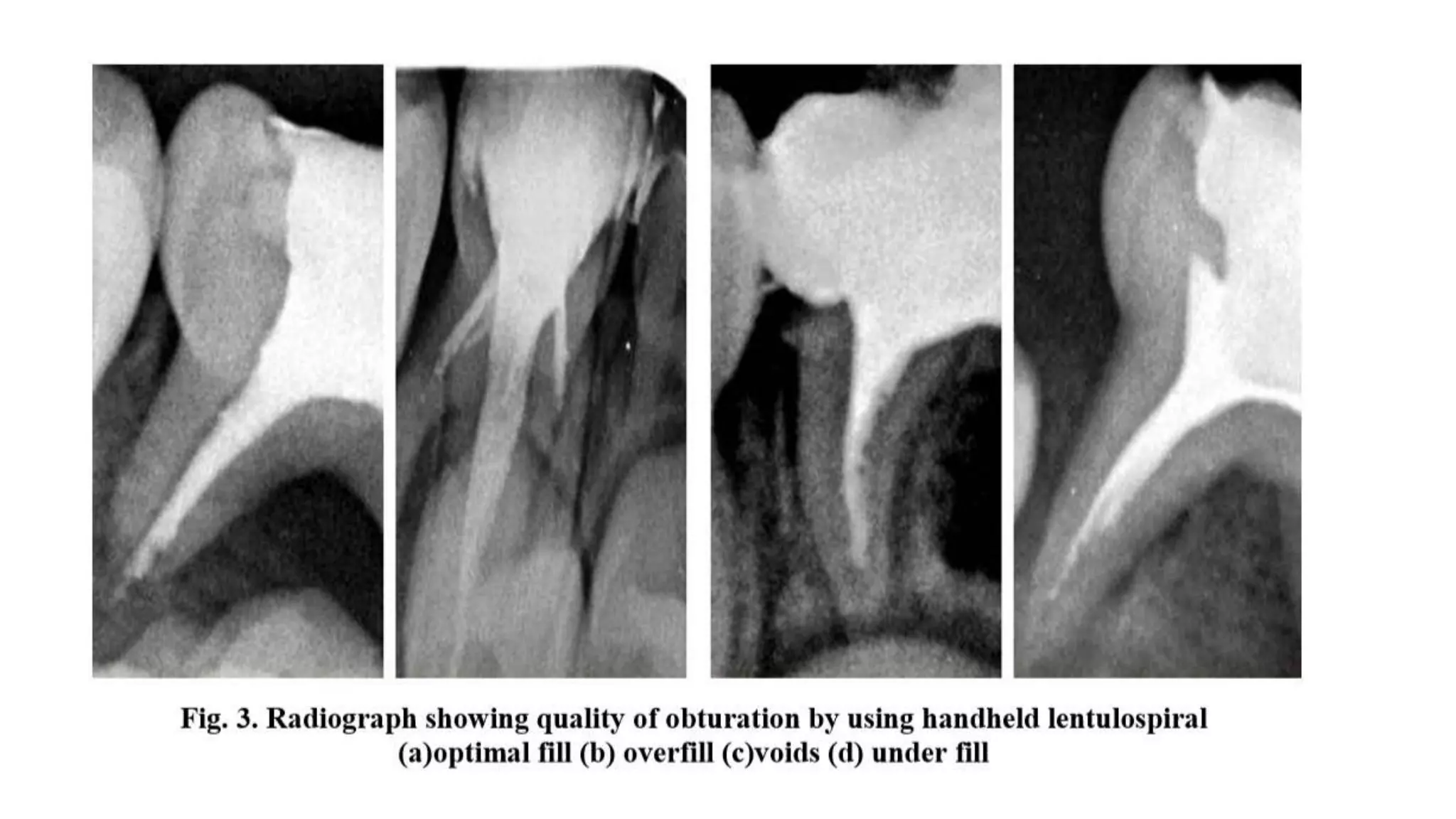 Obturation Techniques in Primary Teeth | PPTX | Dental Health ...
