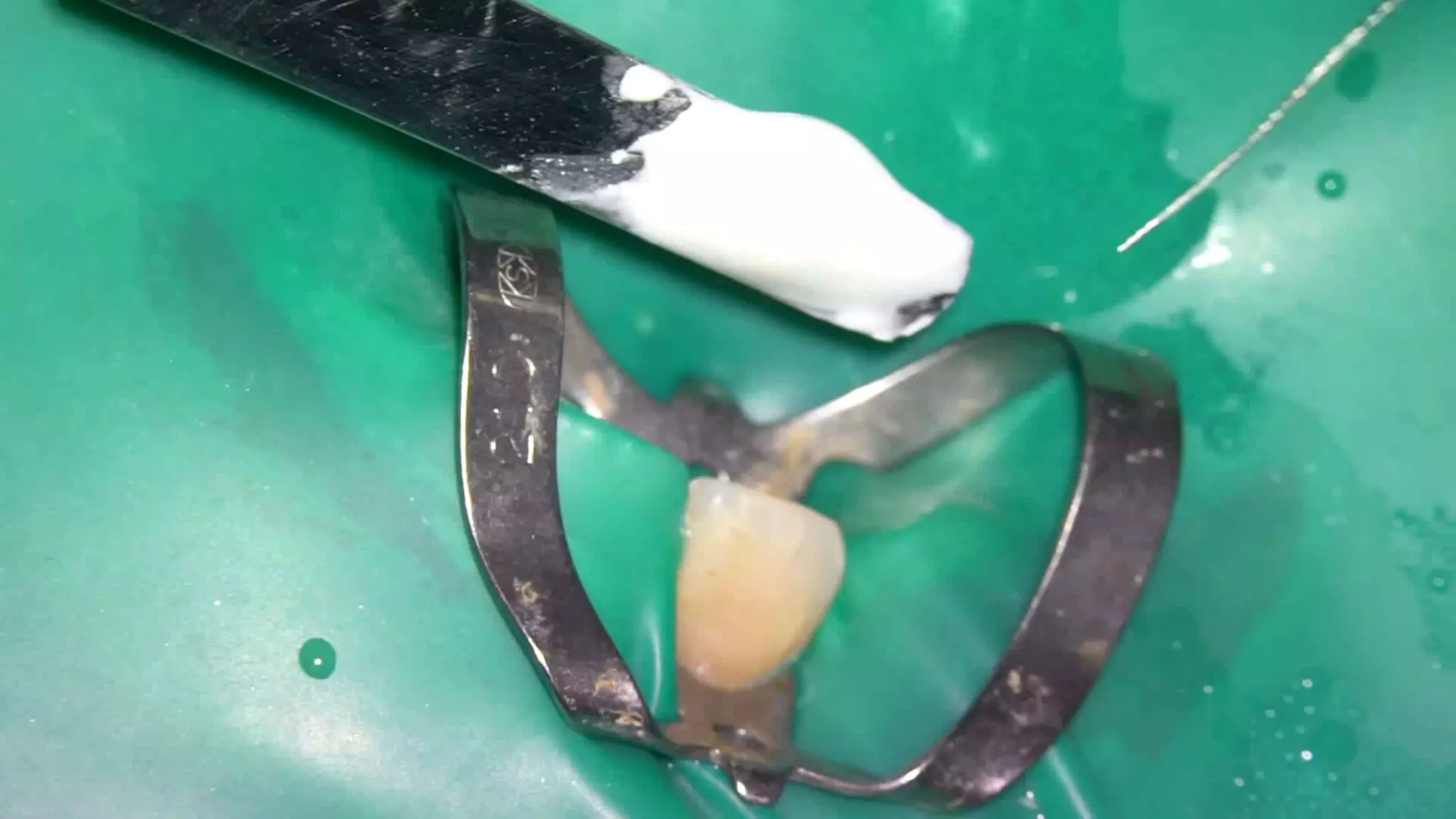 Obturation Techniques in Primary Teeth | PPTX