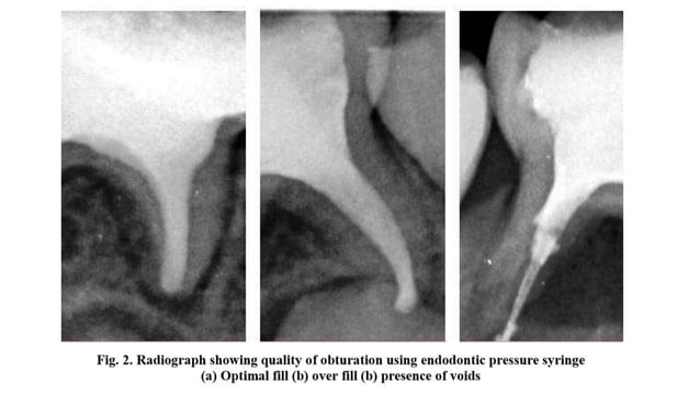 Obturation Techniques in Primary Teeth | PPTX | Dental Health ...
